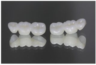 Porcelain Bridges Panorama City | Dental Bridges