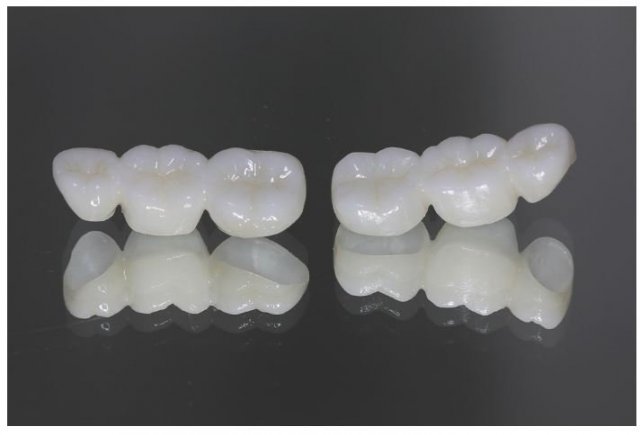 Porcelain Bridges Panorama City | Dental Bridges